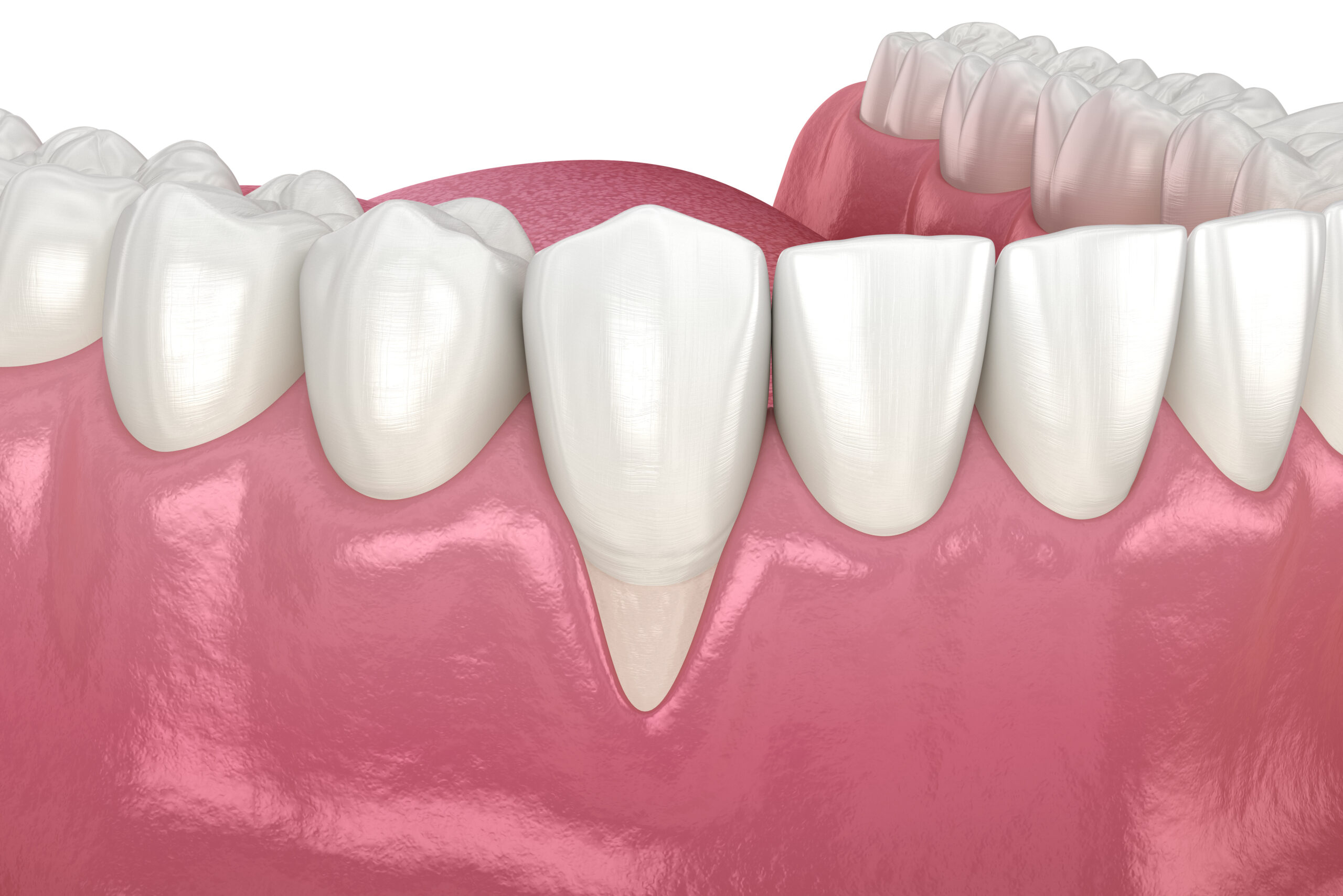 Understanding Gum Recessions: Causes and Solutions - Gorbatov Dentistry ...